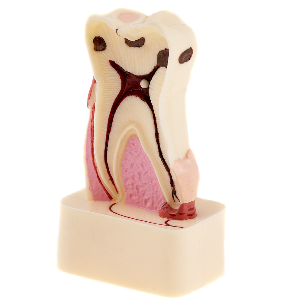 Купити Демонстраційна модель зуба в розрізі, з патологіями М4015 ...