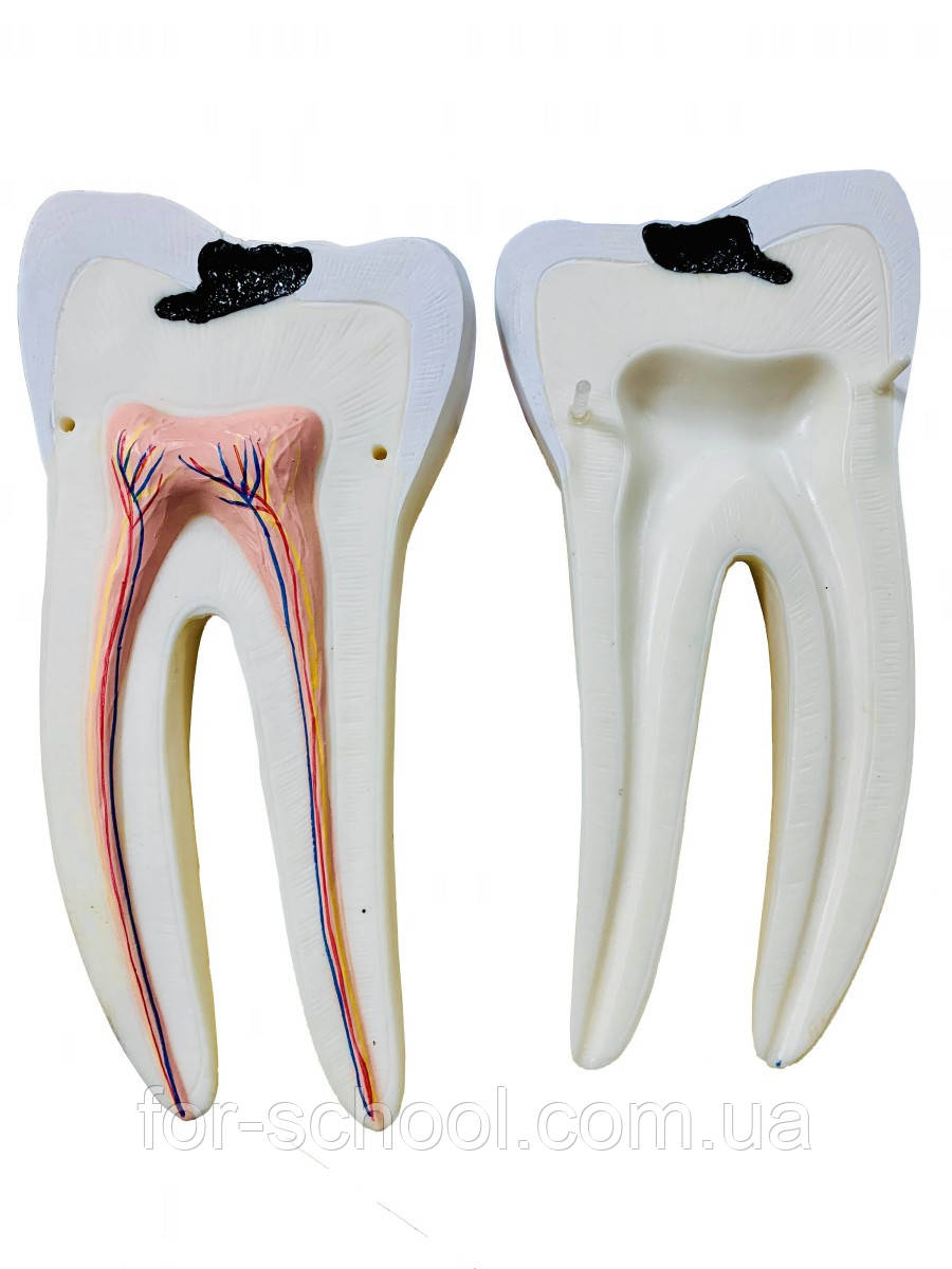 Модель "Будова зуба людини з карієсом": продаж, ціна у Києві. Медичні ...