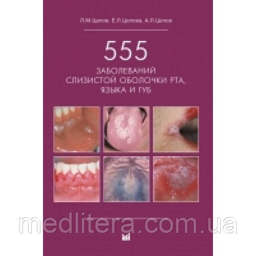 Цепов. 555 заболеваний слизистой оболочки рта, языка и губ (ID#181918538), цена: 300 ₴, купить ...