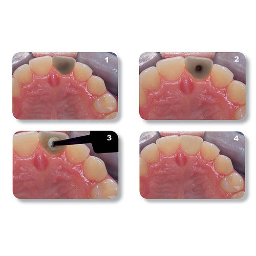 Купить ENDO-WHITE (Ендо-Уайт) Препарат для відбілювання кореневих ...