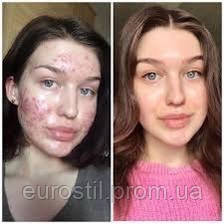 Iзотек 10 мг 30таб Ізотек izotek акнетин акне роакутан вугровий висип ...