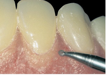 Купити RF90 Stippling Instrumente для додання протезу рельєфності, ціна ...